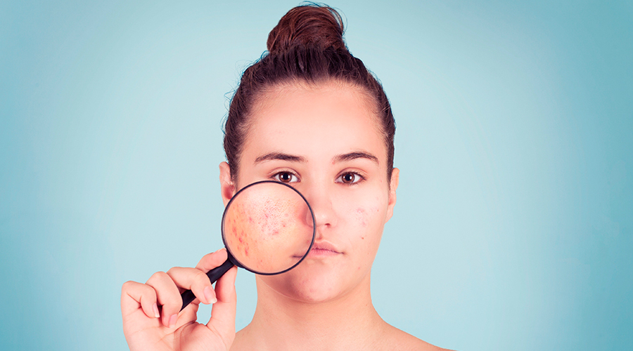 Acne | OA Clinic Dermatologia